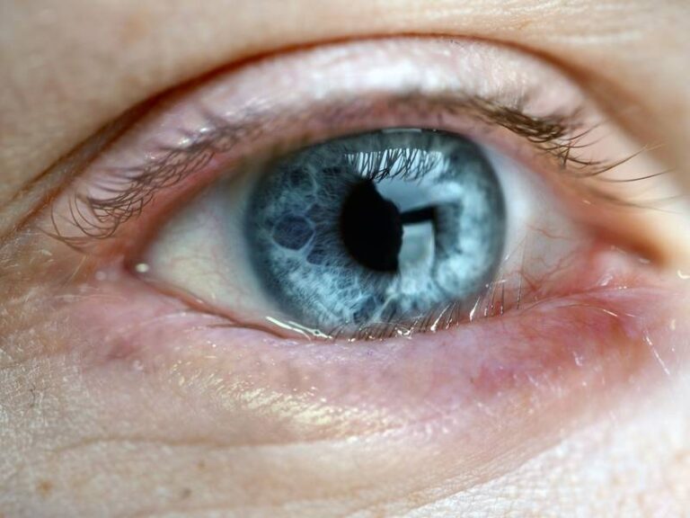 Entropion Eye - Consultants in Ophthalmic and Facial Plastic Surgery