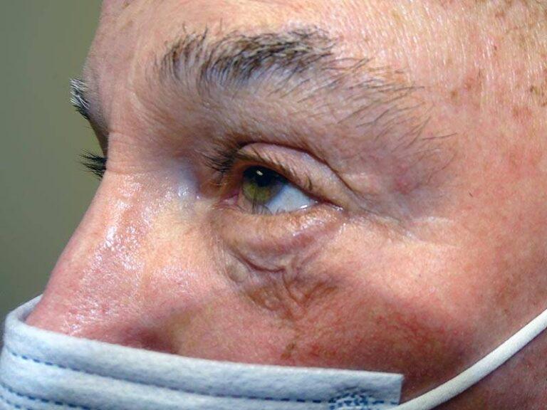 What is an Entropion Eye? - Consultants in Ophthalmic and Facial ...