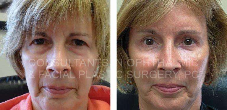 Endoscopic forehead and brow lift / Blepharoplasty of both upper lids ...