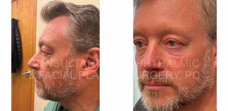 Blepharoplasty of both upper lids / Transconjunctival excision ...