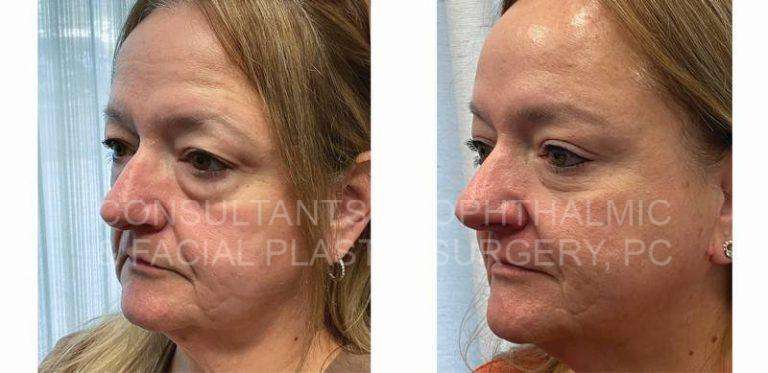 Endoscopic forehead and brow lift / Blepharoplasty of both upper lids ...