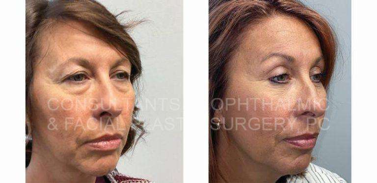 Endoscopic forehead and brow lift / Transconjunctival excision ...