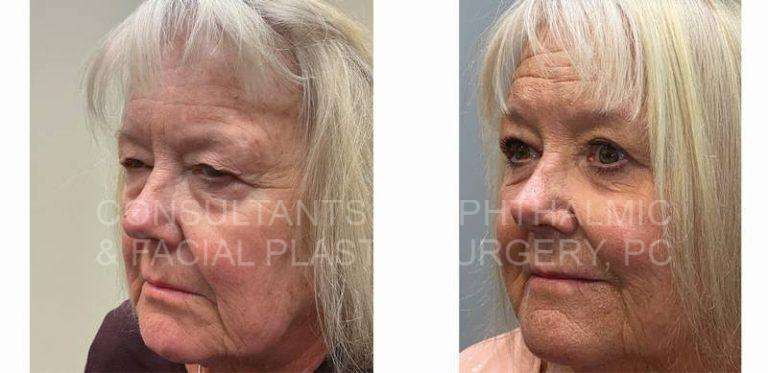 Repair ptosis both upper lids / Transconjunctival excision herniated ...