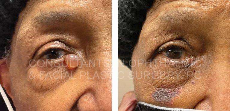 Excision mass right medial canthus with tissue rearrangement closure ...