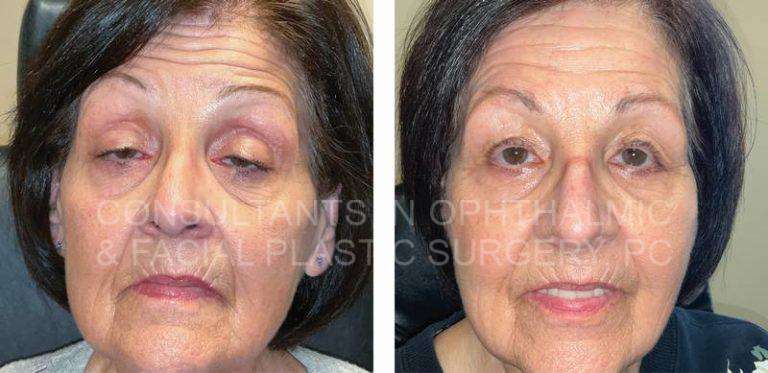 Repair ptosis both upper lids, with frontalis slings - Consultants in ...