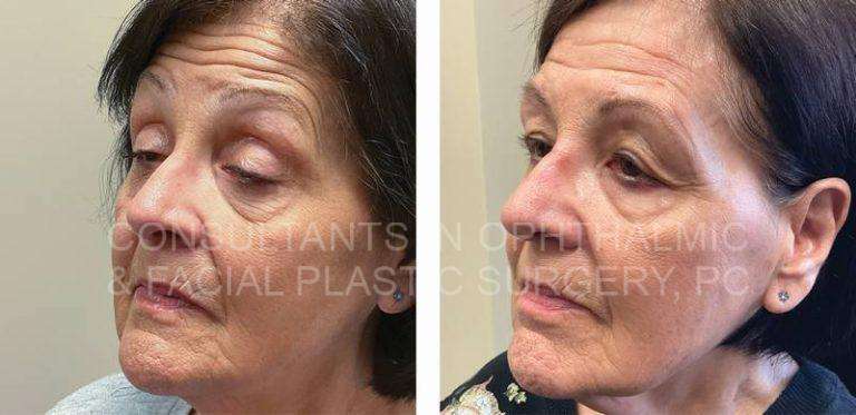 Repair ptosis both upper lids, with frontalis slings - Consultants in ...