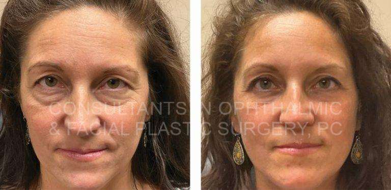 Transconjunctival excision herniated orbital fat both lower lids ...