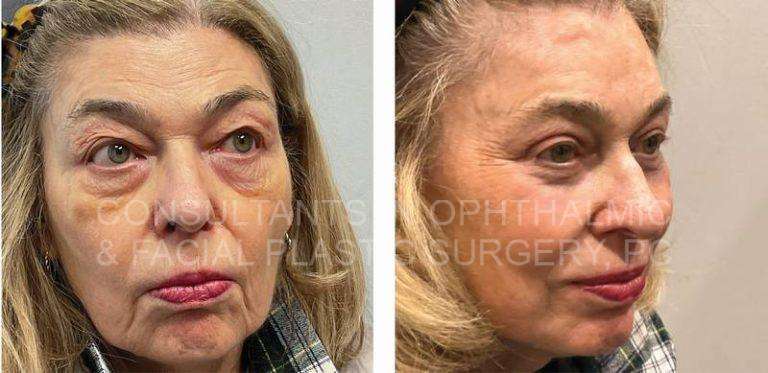 Endoscopic forehead and brow lift / Repair ptosis both upper lids ...