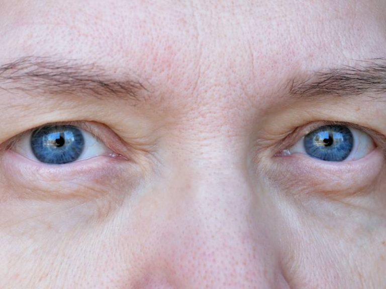 What Are The Symptoms Of Droopy Upper Eyelids? - Consultants in ...