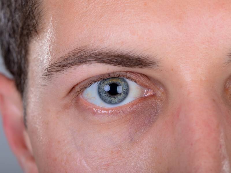 What Can Cause An Ectropion Eye? - Consultants in Ophthalmic and Facial ...