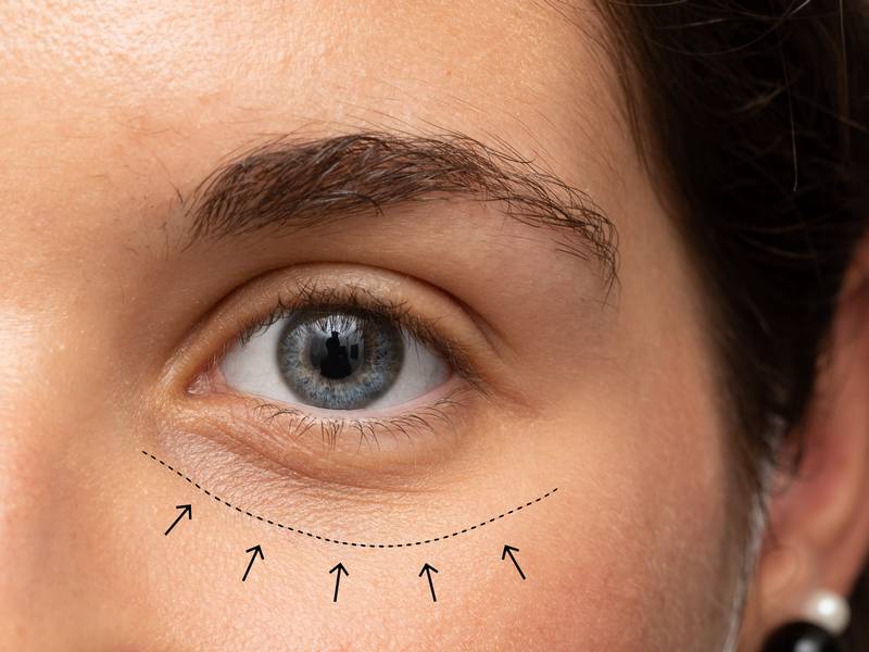 3 Ways Eye Bag Surgery Boosts Your Confidence - Consultants in ...